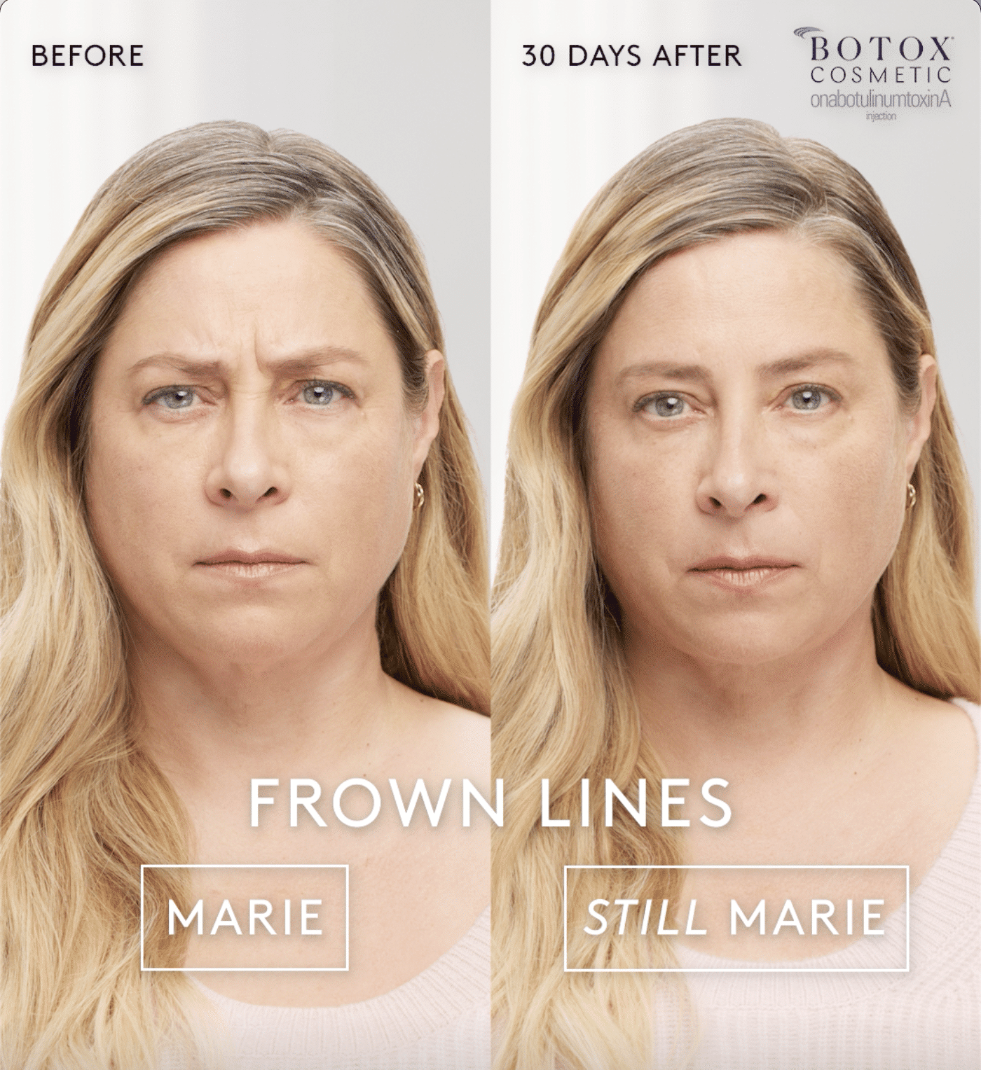 BOTOX Palm Springs - Dysport Palm Desert - Wrinkle Relaxers